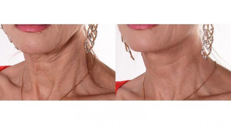 How To Reduce Double Chin With A Tape - 365 gorgeous
